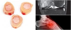 Marrow Edema: Causes, Symptoms, Diagnosis, and Treatment
