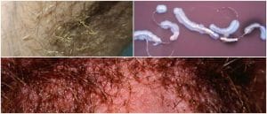 Trichomycosis: Causes, Symptoms, Diagnosis, and Treatment